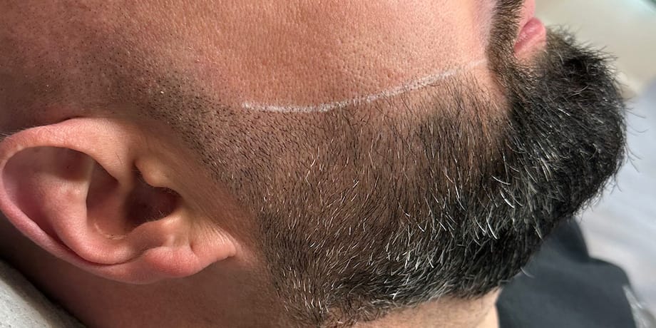 Expert Scalp Micropigmentation in NYC | Hair Loss Solutions