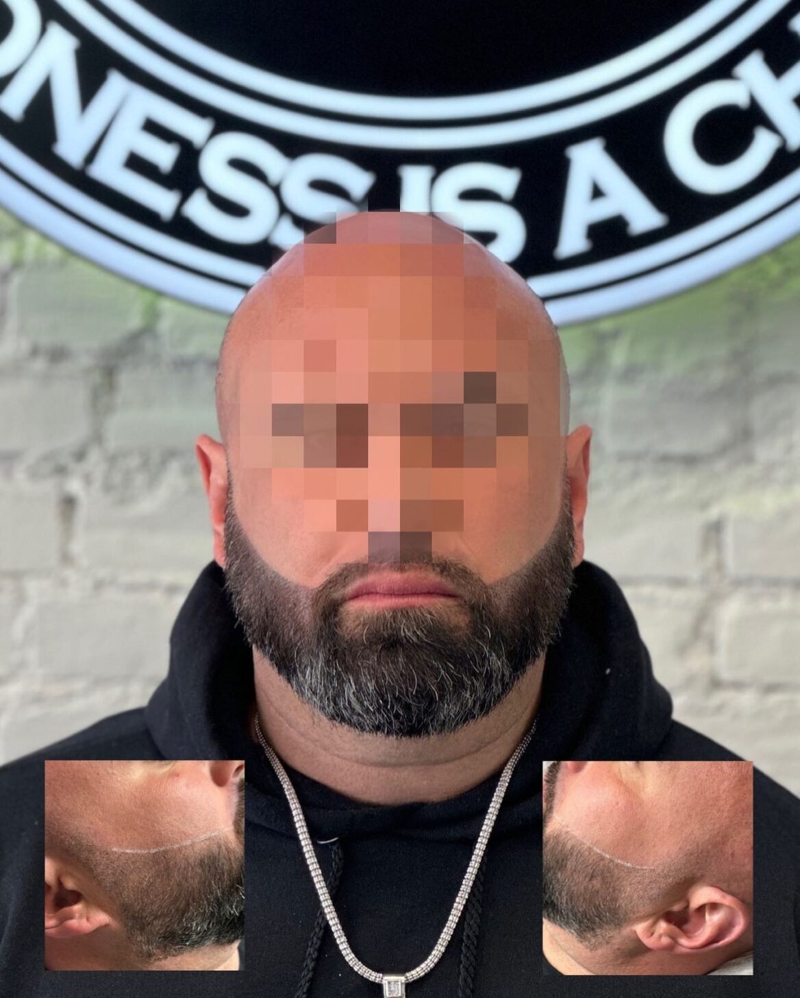 Expert Scalp Micropigmentation in NYC | Hair Loss Solutions