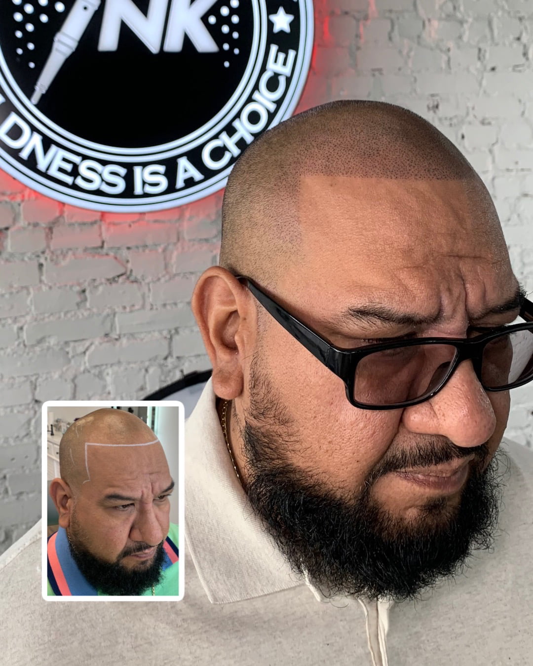 Expert Scalp Micropigmentation in NYC | Hair Loss Solutions